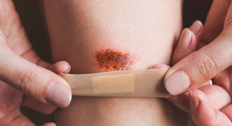 Non-suicidal Self-injury (NSSI) as a coping mechanism